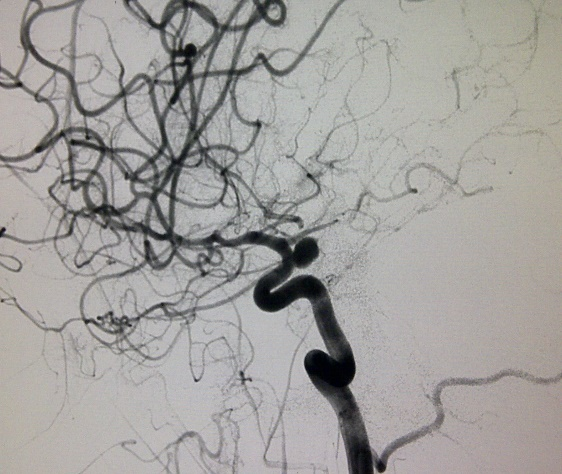 Dr SK Gupta - Spinal & Cranial Endoscopy, Neuroendovascular Surgery ...