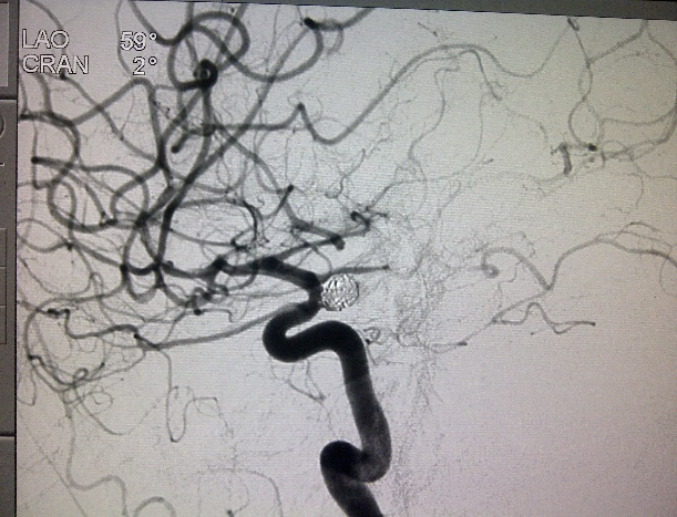 Dr SK Gupta - Spinal & Cranial Endoscopy, Neuroendovascular Surgery ...