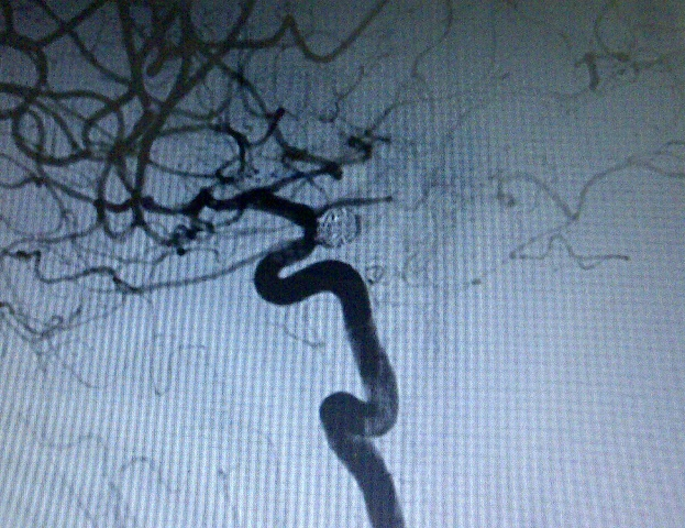 Dr SK Gupta - Spinal & Cranial Endoscopy, Neuroendovascular Surgery ...