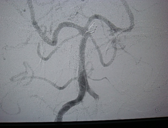 Dr SK Gupta - Spinal & Cranial Endoscopy, Neuroendovascular Surgery ...